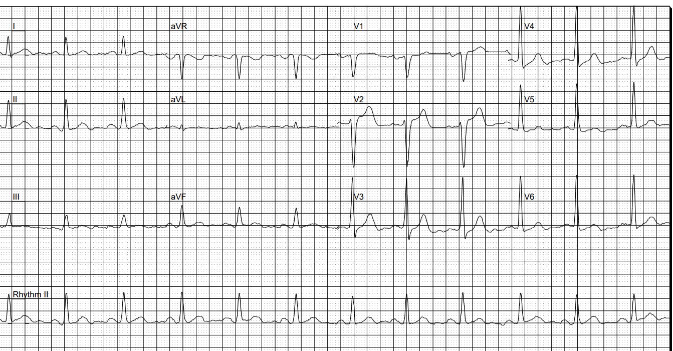 Electrocardiogram: What to Know about the Test - Urgent Heart Clinic ...